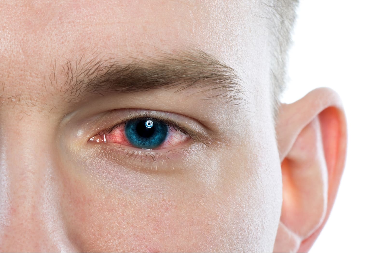 How to Protect Your Eyes From Pink Eye | Jamaica Vision Center